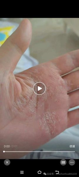 鹅掌癣初期症状图片_鹅掌癣会传染吗-第2张图片-山城妙识