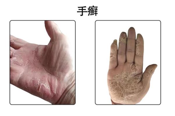 鹅掌癣初期症状图片_鹅掌癣会传染吗-第3张图片-山城妙识