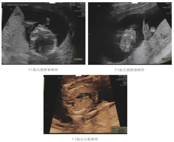 怀孕孩子畸形的征兆_孕期B超异常有哪些表现-第1张图片-山城妙识