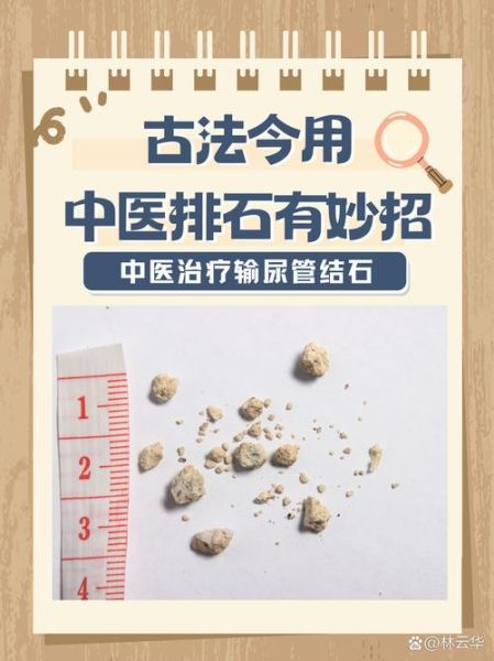 肾结石怎么治疗_肾结石怎么办-第2张图片-山城妙识