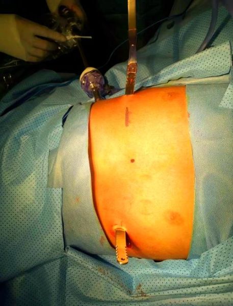 男生鸡胸症状图_鸡胸矫正方法有哪些-第2张图片-山城妙识