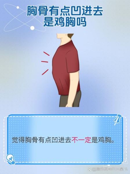 男生鸡胸症状图_鸡胸矫正方法有哪些-第3张图片-山城妙识