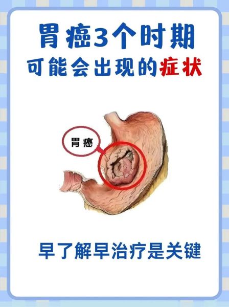 胃癌早期症状有哪些_胃癌早期会疼吗-第2张图片-山城妙识 胃癌早期症状有哪些_胃癌早期会疼吗-第2张图片-山城妙识