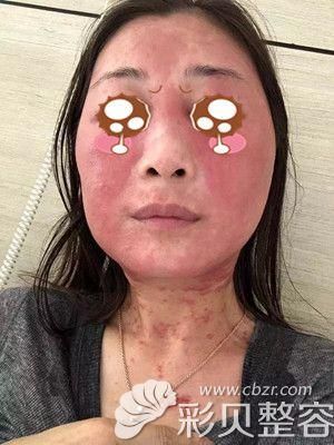 海鲜过敏皮肤症状图片大全_如何快速识别-第2张图片-山城妙识