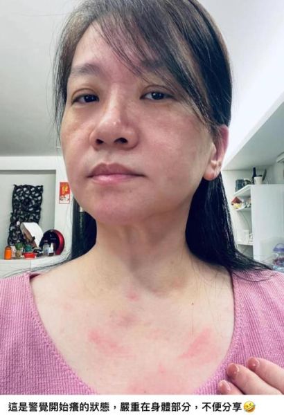 海鲜过敏皮肤症状图片大全_如何快速识别-第1张图片-山城妙识