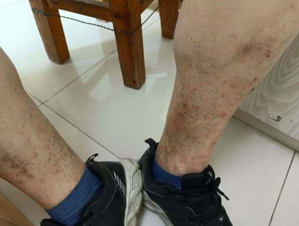 女性血糖高有哪些症状_血糖高初期表现-第2张图片-山城妙识