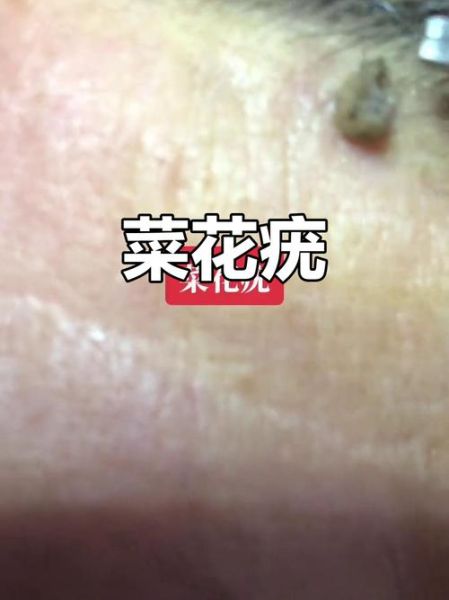 菜花病早期症状图片_菜花病初期长什么样-第1张图片-山城妙识