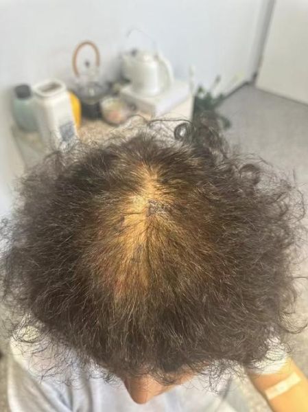 头顶头发稀少是什么原因_头顶脱发还能恢复吗-第1张图片-山城妙识