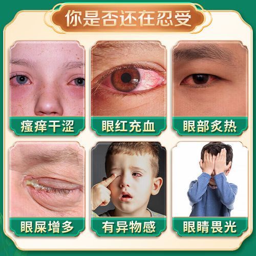 过敏性结膜炎用什么眼药水_能长期滴吗-第3张图片-山城妙识