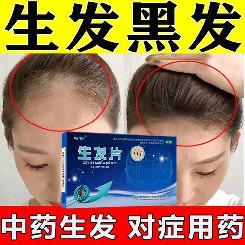 脱发吃什么药管用_脱发用药多久见效-第3张图片-山城妙识 脱发吃什么药管用_脱发用药多久见效-第3张图片-山城妙识