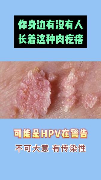 菜花肉芽早期症状图片_如何辨别真假-第1张图片-山城妙识 菜花肉芽早期症状图片_如何辨别真假-第1张图片-山城妙识