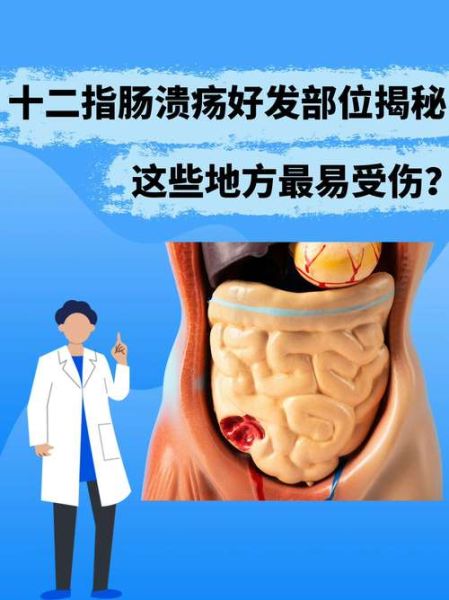 十二指肠溃疡的症状有哪些_十二指肠溃疡会自愈吗-第2张图片-山城妙识