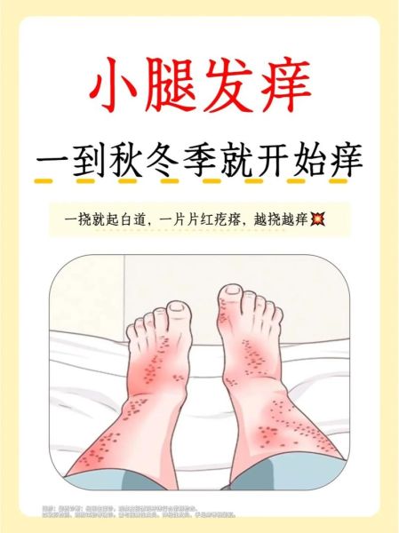 皮肤干燥瘙痒怎么办_冬天皮肤干痒如何快速止痒-第3张图片-山城妙识