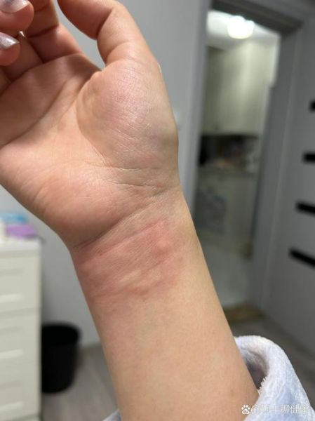 吃螃蟹过敏怎么办_吃螃蟹过敏的症状及急救-第1张图片-山城妙识