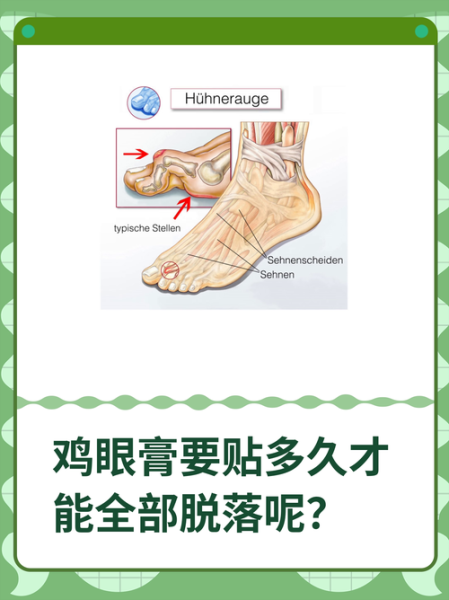 鸡眼贴自然脱落还是要挖开_鸡眼贴多久能掉-第1张图片-山城妙识