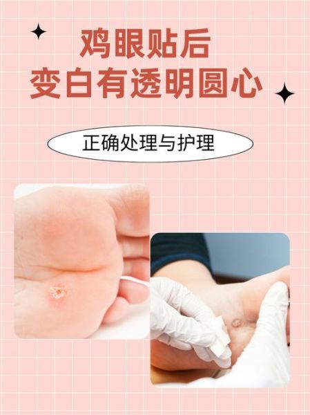 鸡眼贴自然脱落还是要挖开_鸡眼贴多久能掉-第2张图片-山城妙识