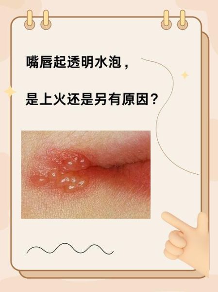 上火嘴唇起泡怎么办_嘴角起泡快速消除方法-第3张图片-山城妙识