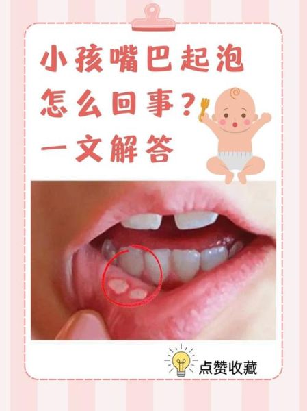 上火嘴唇起泡怎么办_嘴角起泡快速消除方法-第2张图片-山城妙识