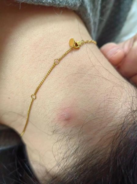 疖子怎么治好的最快_疖子几天能好-第1张图片-山城妙识