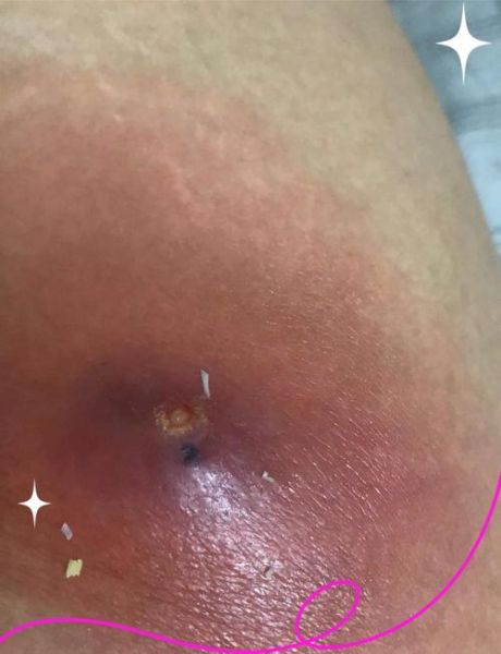 疖子怎么治好的最快_疖子几天能好-第3张图片-山城妙识