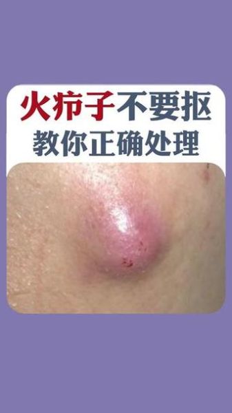 疖子怎么治好的最快_疖子几天能好-第2张图片-山城妙识