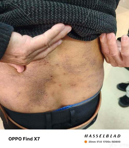 淀粉样变肾病能活多久_早期症状有哪些-第1张图片-山城妙识 淀粉样变肾病能活多久_早期症状有哪些-第1张图片-山城妙识