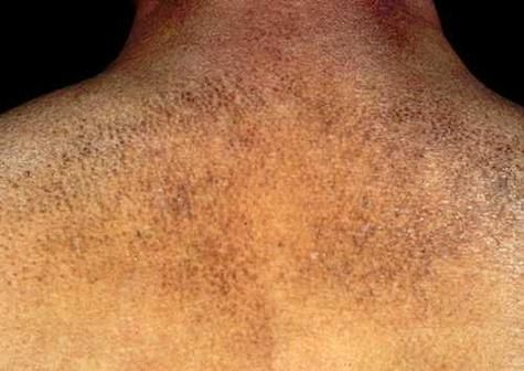 淀粉样变肾病能活多久_早期症状有哪些-第2张图片-山城妙识 淀粉样变肾病能活多久_早期症状有哪些-第2张图片-山城妙识