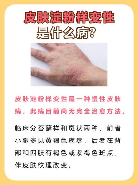 淀粉样变肾病能活多久_早期症状有哪些-第3张图片-山城妙识 淀粉样变肾病能活多久_早期症状有哪些-第3张图片-山城妙识