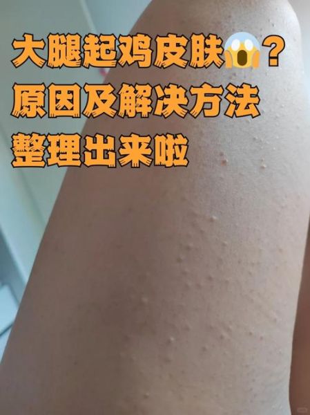 严重鸡皮肤图片大全_怎么改善最有效-第2张图片-山城妙识