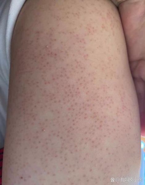 严重鸡皮肤图片大全_怎么改善最有效-第3张图片-山城妙识