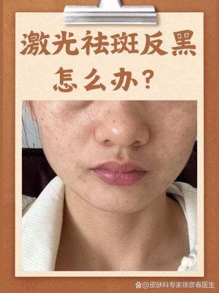 永久祛斑什么方法最好_激光祛斑会反弹吗-第1张图片-山城妙识