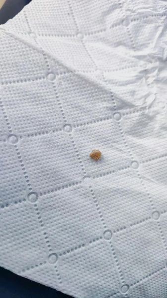 肾结石严重吗_肾结石能自愈吗-第2张图片-山城妙识