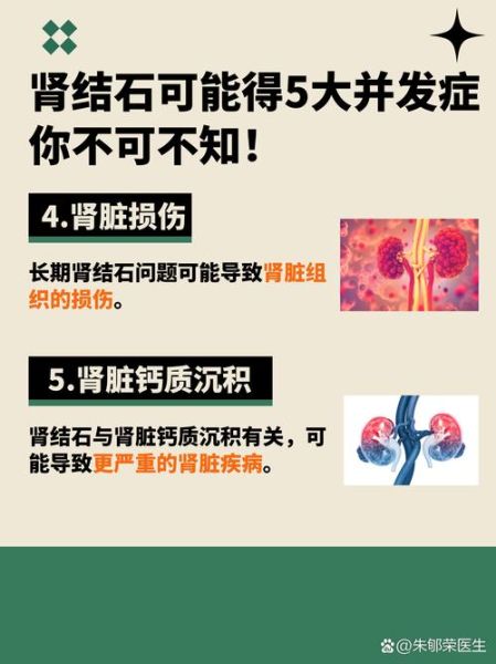 肾结石严重吗_肾结石能自愈吗-第3张图片-山城妙识