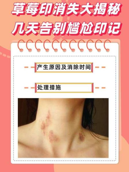 草莓印怎么快速消除_草莓印一晚上能去掉吗-第1张图片-山城妙识