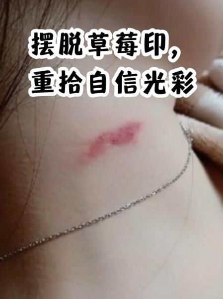 草莓印怎么快速消除_草莓印一晚上能去掉吗-第2张图片-山城妙识