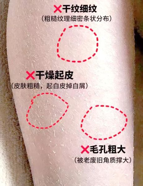 皮肤干燥脱屑像雪花怎么办_为什么皮肤会起皮屑-第2张图片-山城妙识 皮肤干燥脱屑像雪花怎么办_为什么皮肤会起皮屑-第2张图片-山城妙识
