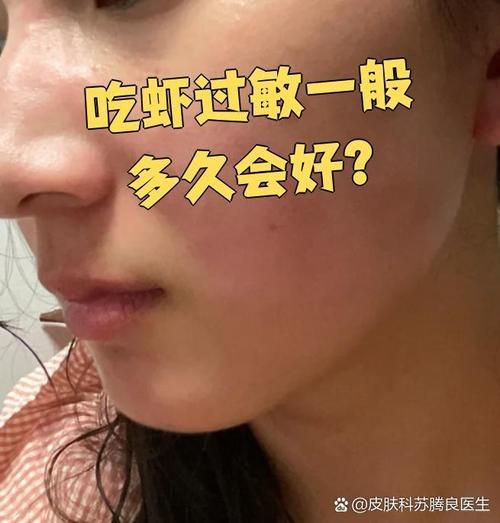 海鲜过敏多久起反应_吃完海鲜过敏症状多久出现-第2张图片-山城妙识