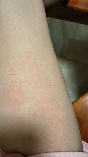 海鲜过敏多久起反应_吃完海鲜过敏症状多久出现-第3张图片-山城妙识