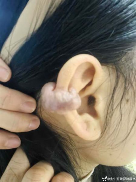 拉皮手术后耳朵疤痕多久消失_拉皮手术后耳朵变形怎么办-第1张图片-山城妙识 拉皮手术后耳朵疤痕多久消失_拉皮手术后耳朵变形怎么办-第1张图片-山城妙识