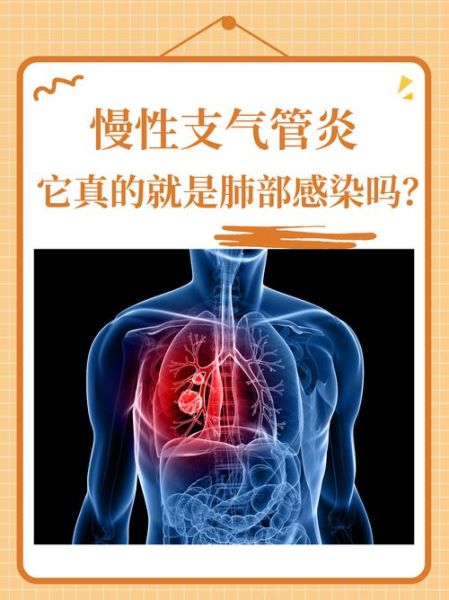 慢性支气管炎会癌变吗_长期咳嗽危险吗-第1张图片-山城妙识