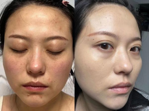 祛斑排行榜第一名是哪个_效果真的好吗-第1张图片-山城妙识 祛斑排行榜第一名是哪个_效果真的好吗-第1张图片-山城妙识