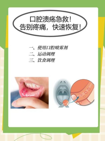 口腔溃疡怎么治最快_口腔溃疡最有效的治疗方法-第1张图片-山城妙识