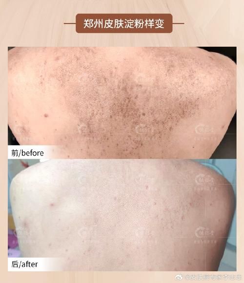 淀粉样变皮肤病偏方_淀粉样变皮肤病民间疗法-第3张图片-山城妙识 淀粉样变皮肤病偏方_淀粉样变皮肤病民间疗法-第3张图片-山城妙识