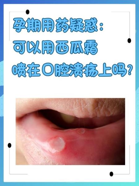 西瓜霜能治口腔溃疡吗_西瓜霜喷剂怎么用-第1张图片-山城妙识