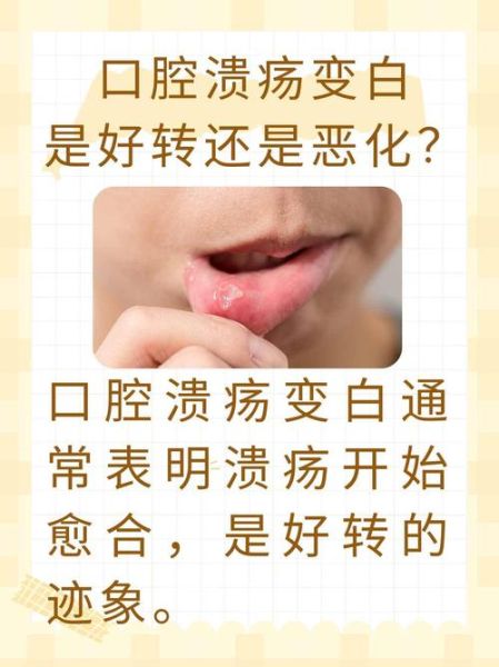 口腔溃疡变白是好转还是恶化_如何判断-第1张图片-山城妙识