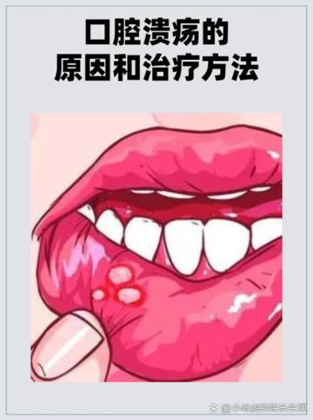 口腔溃疡变白是好转还是恶化_如何判断-第2张图片-山城妙识