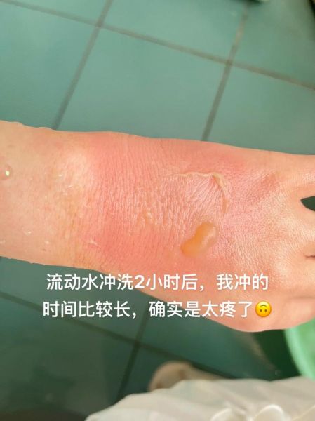 开水烫伤怎么办_烫伤后怎么处理不留疤-第1张图片-山城妙识 开水烫伤怎么办_烫伤后怎么处理不留疤-第1张图片-山城妙识