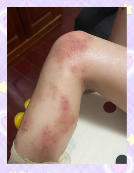 艾蒿过敏源有哪些_艾蒿过敏症状怎么判断-第3张图片-山城妙识