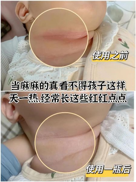 艾蒿过敏源有哪些_艾蒿过敏症状怎么判断-第2张图片-山城妙识