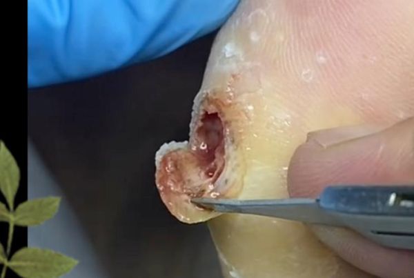 鸡眼挖出来的根图片_鸡眼根长什么样-第1张图片-山城妙识